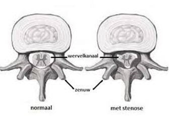 Hernia operatie en/of kanaalstenose - Alrijne Ziekenhuis