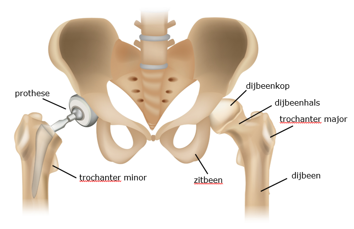 Heupprothese, rapid recovery - Alrijne Ziekenhuis
