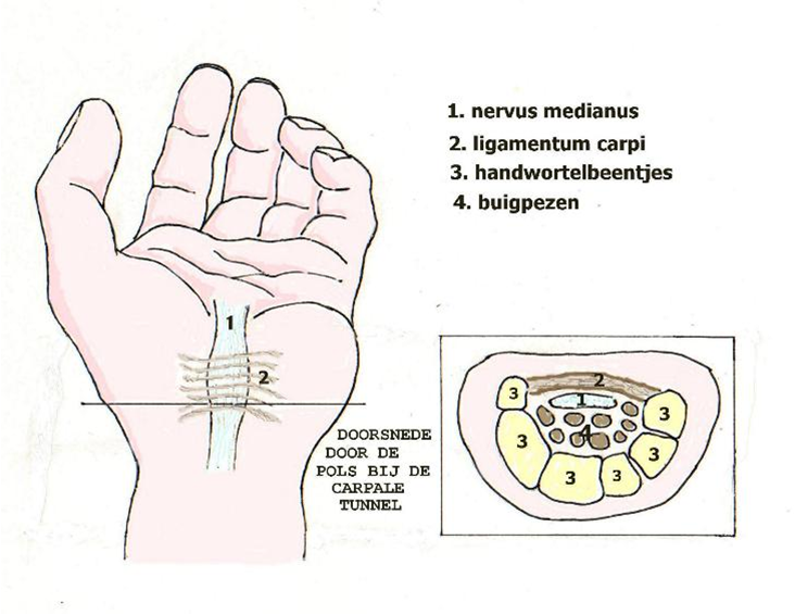 Operatie voor het Carpale Tunnel Syndroom, single visit - Alrijne ...